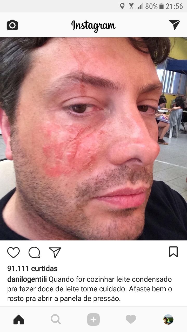 Queimadura de Danilo Gentili é falsa, mas perigo com panela de pressão ...